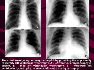 -Arterial Hypertension- | DOC