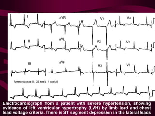 -Arterial Hypertension- | DOC