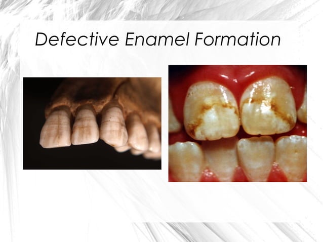 Internal bleaching | PPT | Dental Health | Diseases and Conditions