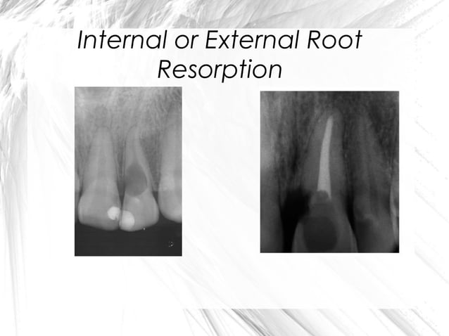Internal bleaching | PPT | Dental Health | Diseases and Conditions