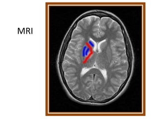 Internal Capsule-Anatomy | PPTX