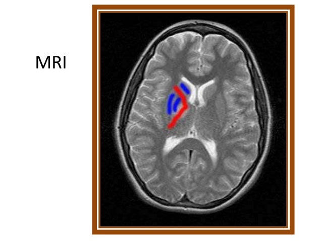 Internal Capsule-Anatomy
