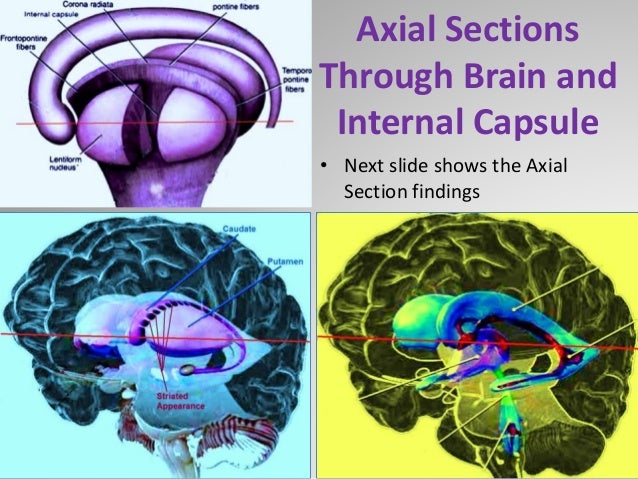 Brain Internal Capsule – Structure Orientation Tracts - Sanjoy Sanyal