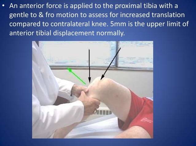 derangement knee ppt | PPTX