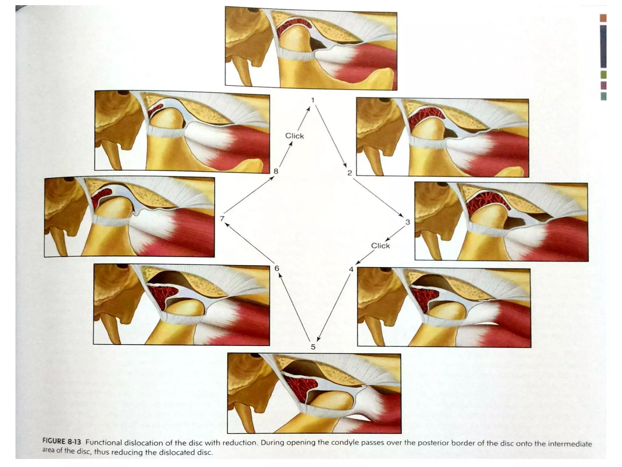 Internal derangement of tmj | PDF