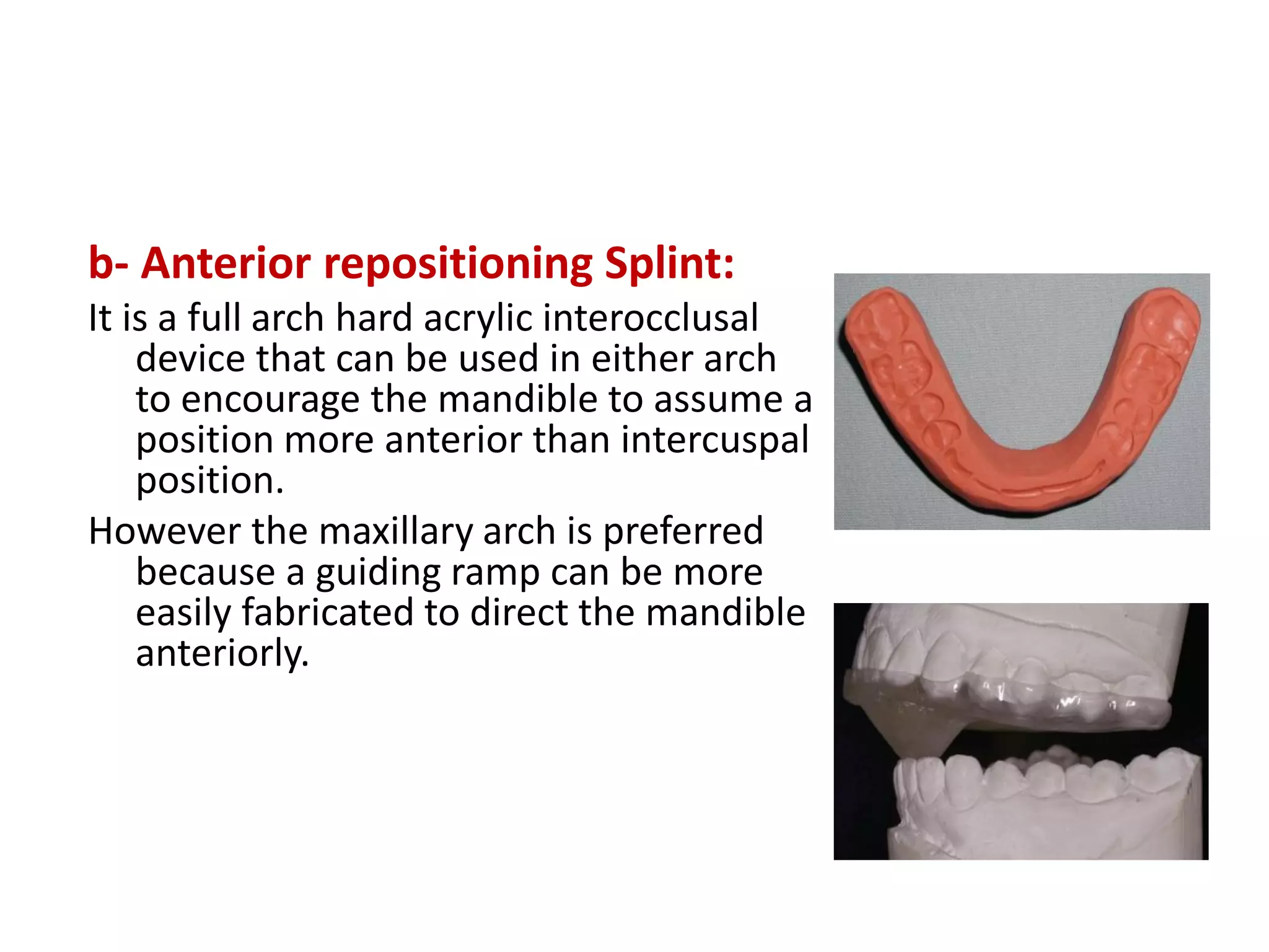Internal derangement of tmj | PDF
