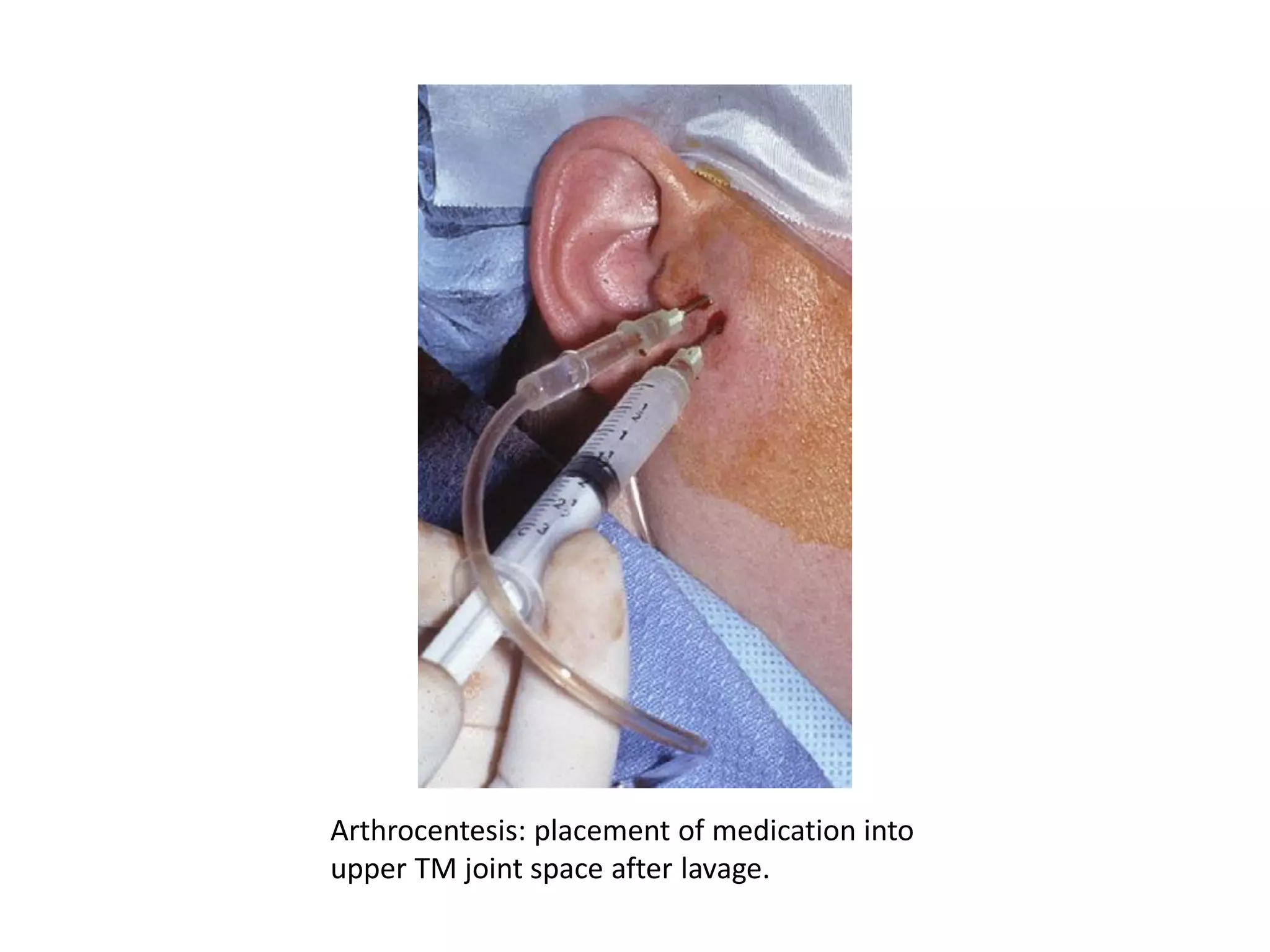Internal derangement of tmj | PDF | Bone and Joint Conditions ...