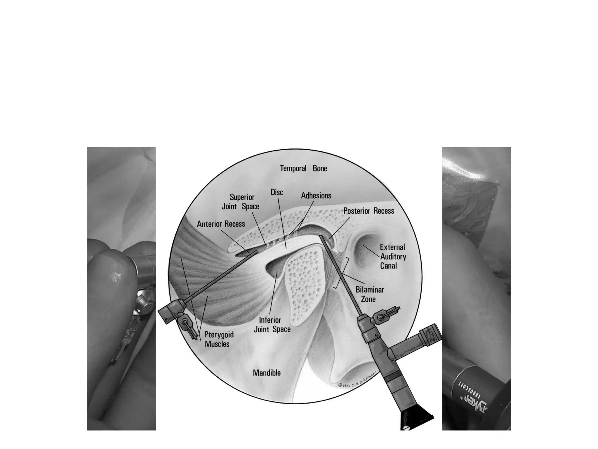 Internal derangement of tmj | PDF