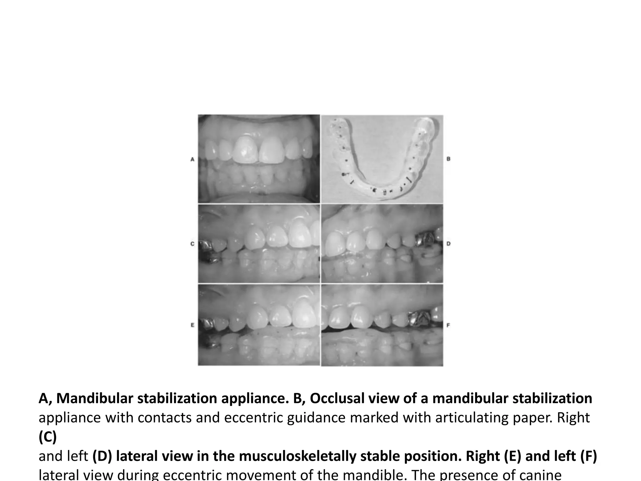 Internal derangement of tmj | PDF