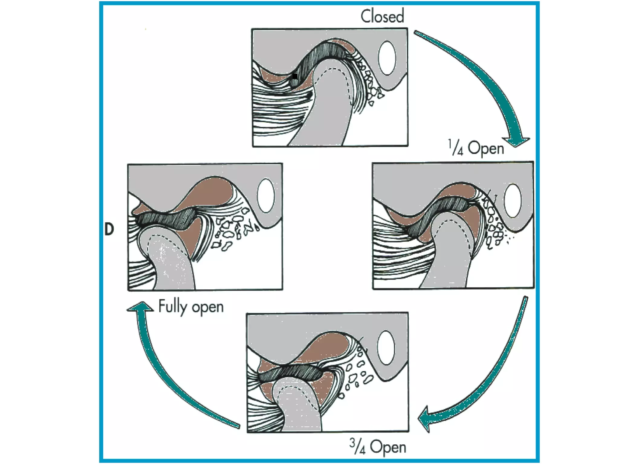 Internal derangement of tmj | PDF