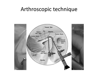 Internal derangement of tmj | PDF