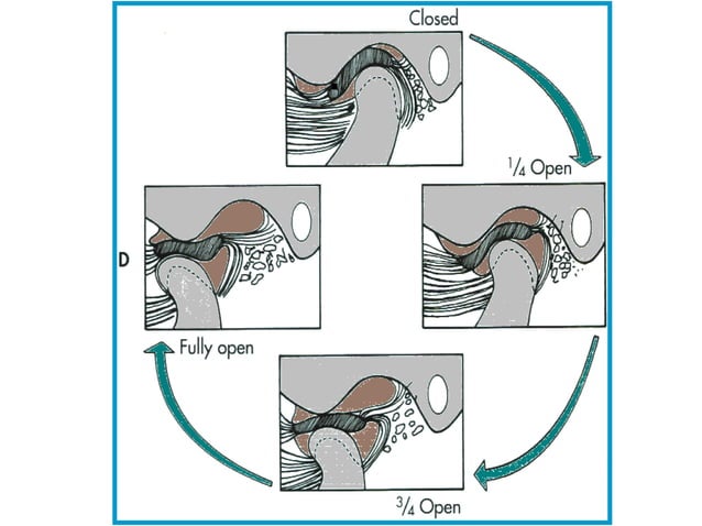 Internal derangement of tmj | PDF | Bone and Joint Conditions ...