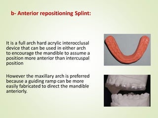 Internal derangement of TMJ | PPTX