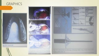 Internal derangements | PPTX