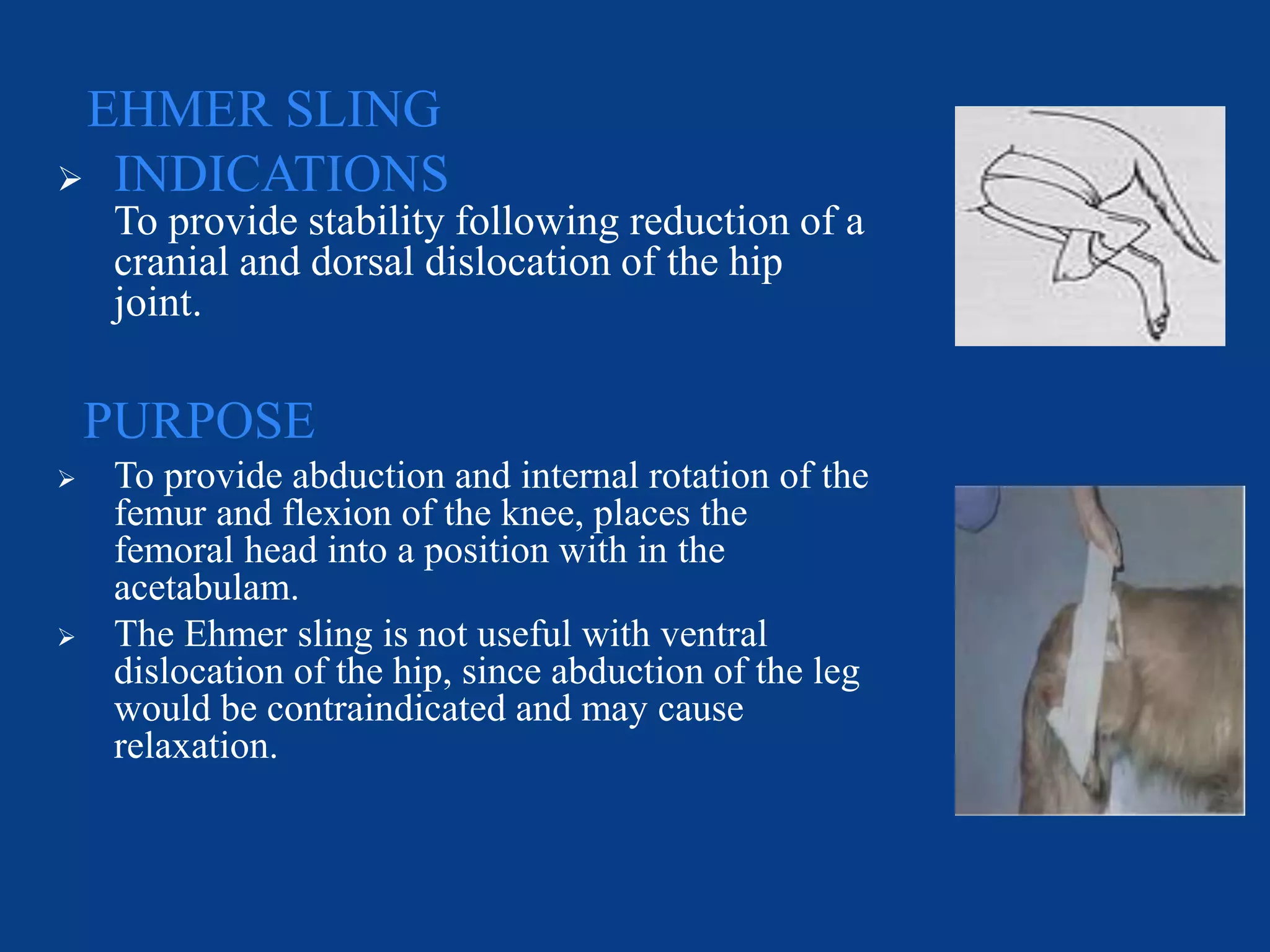 Internal fixation techniques | PPTX