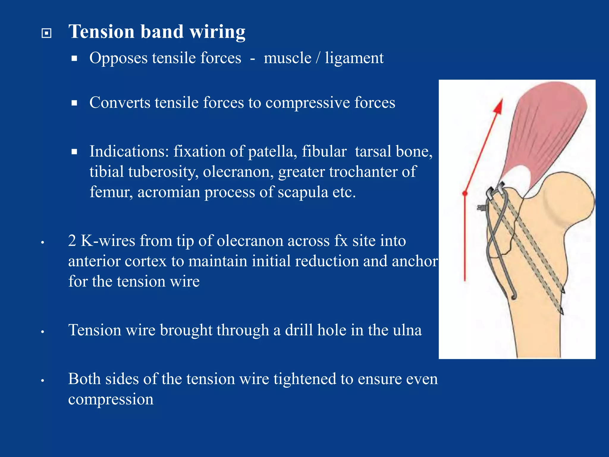 Internal fixation techniques | PPTX