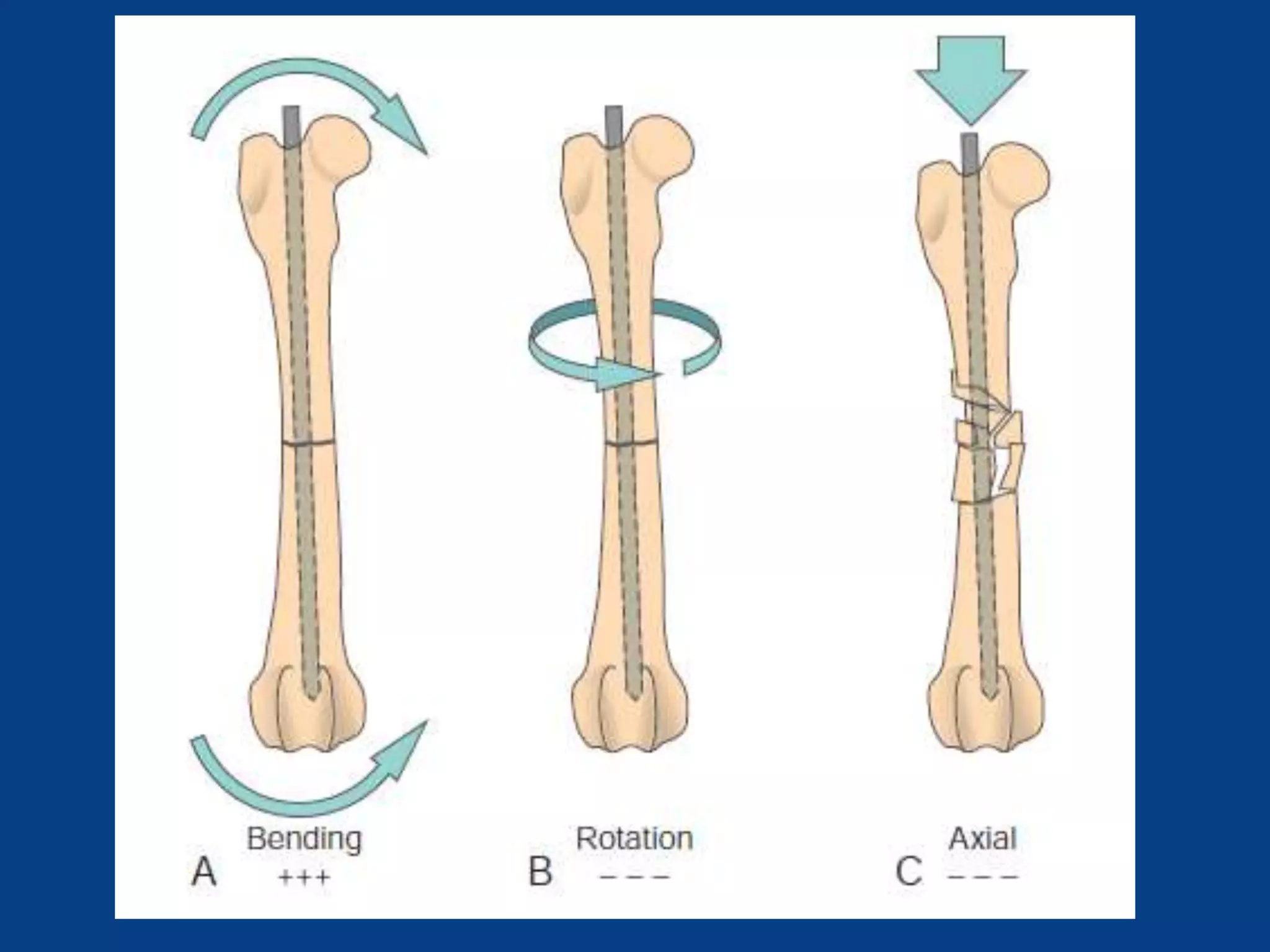 Internal fixation techniques | PPTX