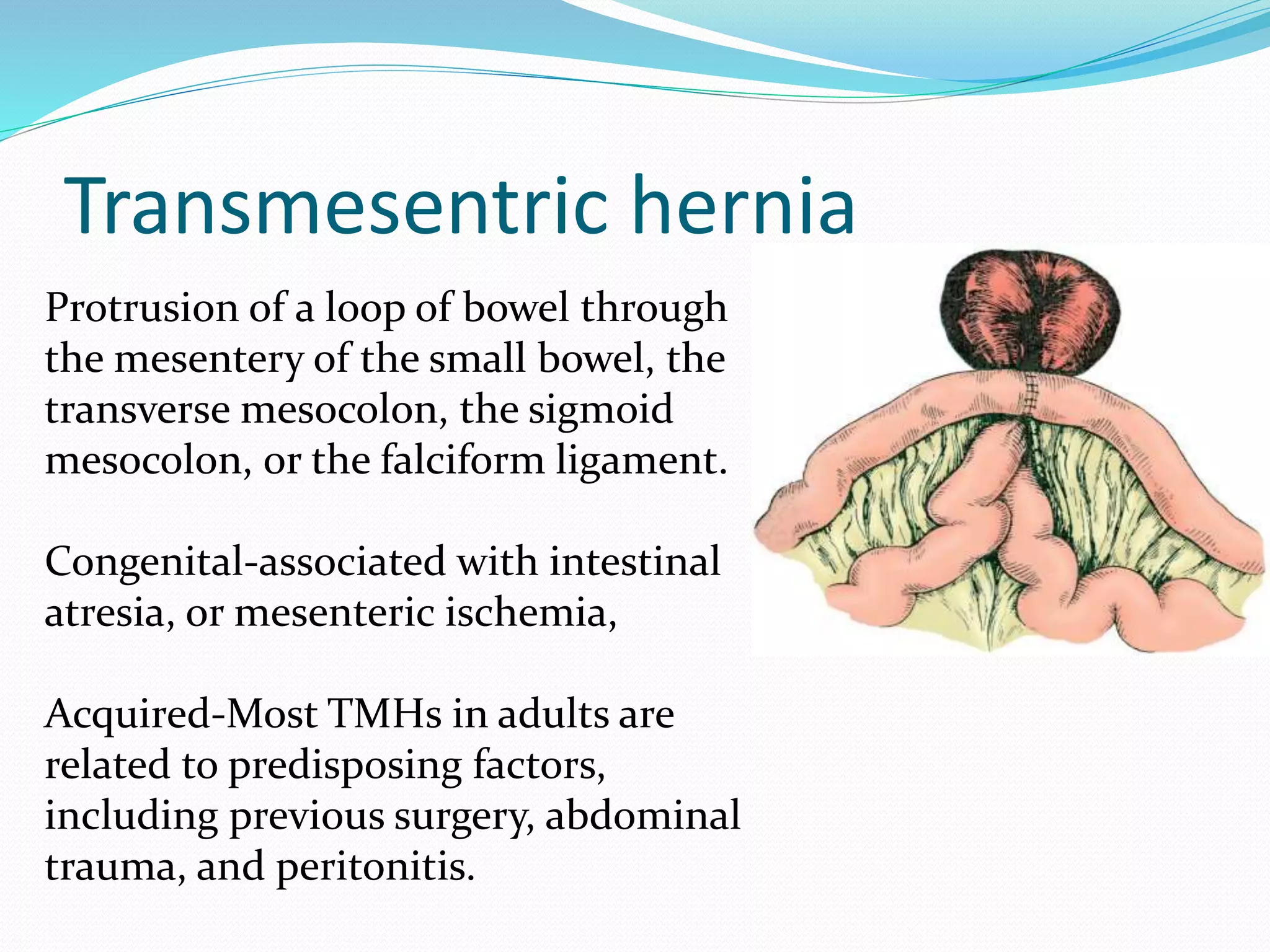 Internal hernia | PPTX
