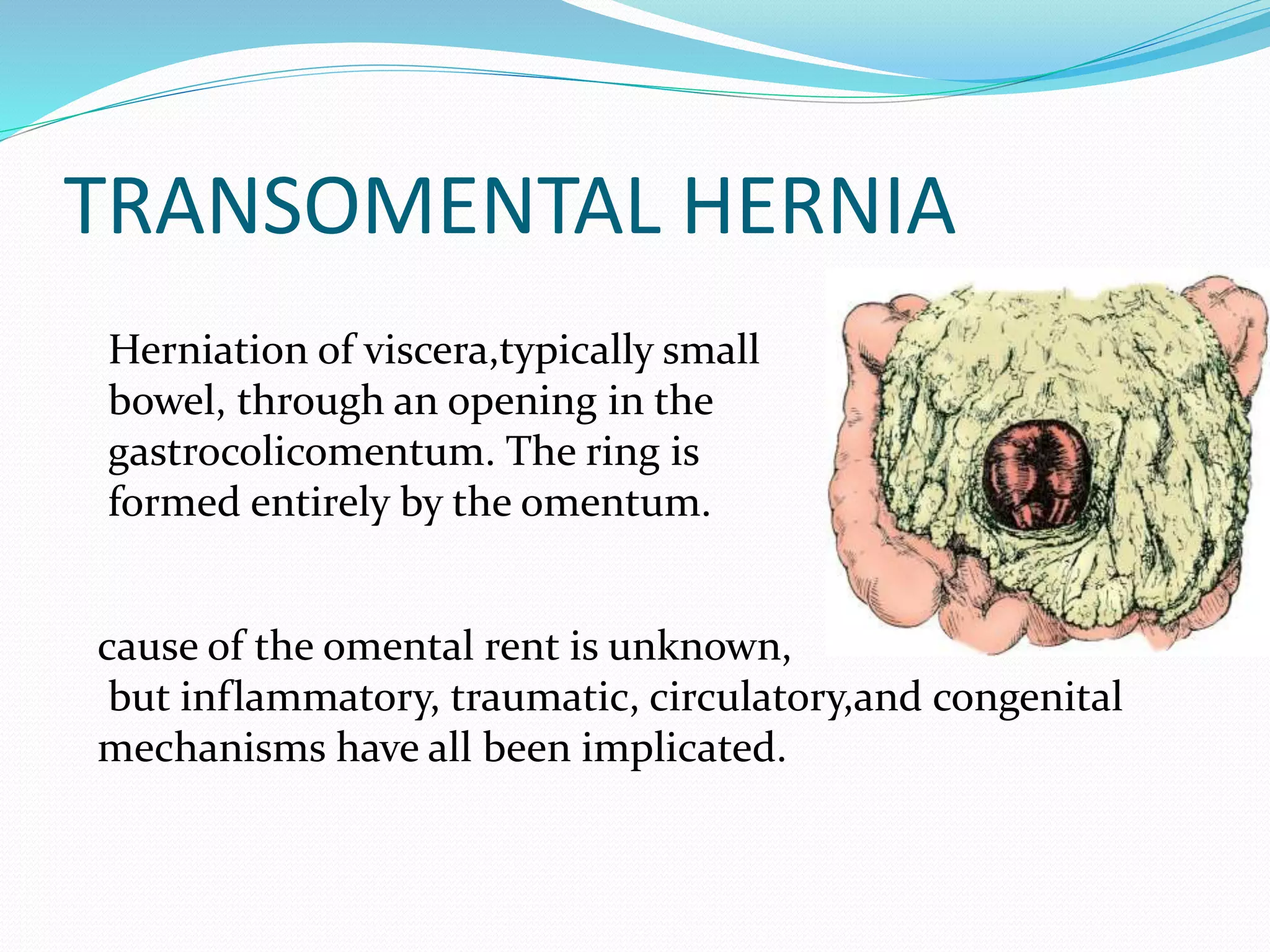 Internal hernia | PPTX