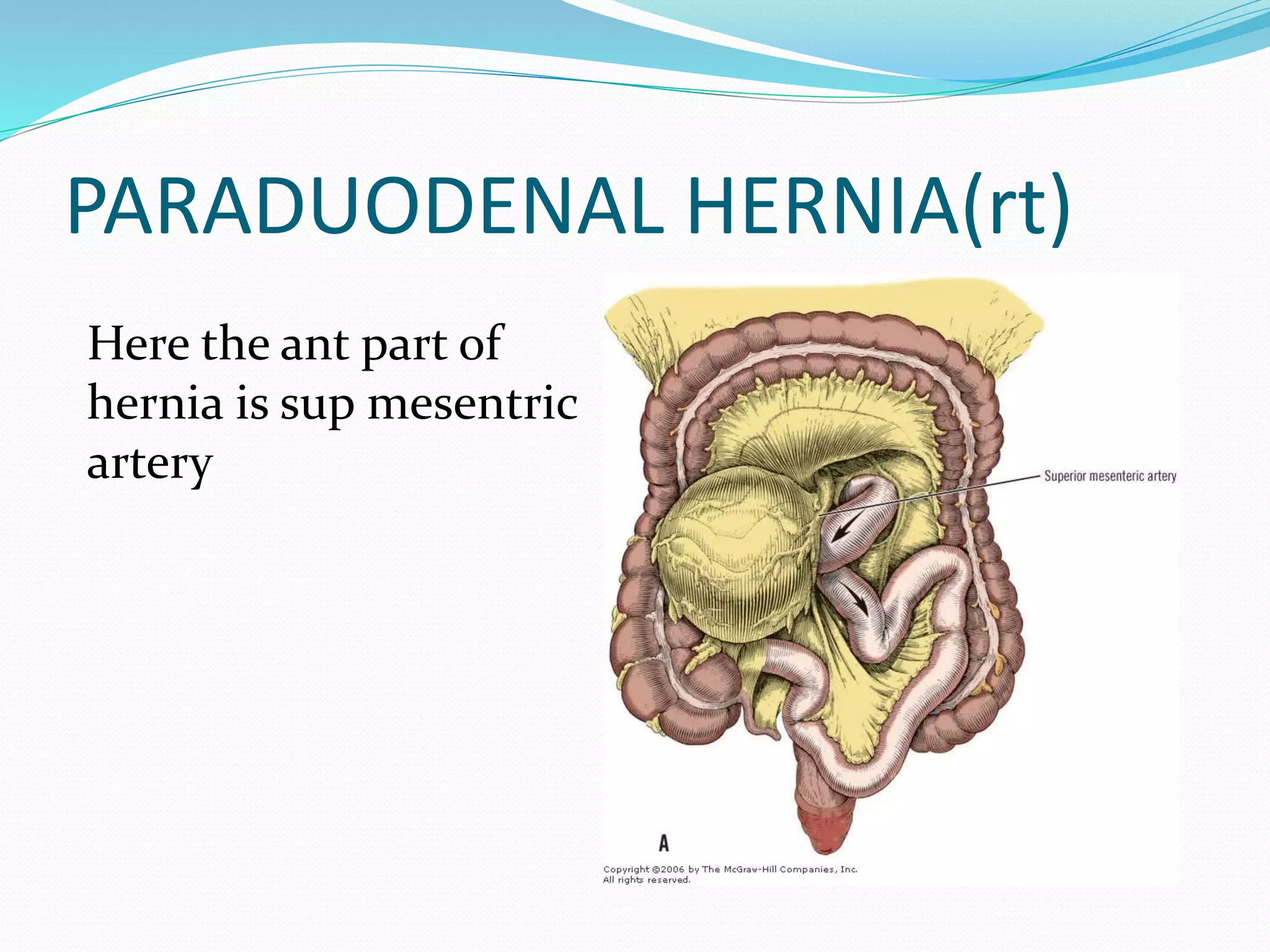 Internal hernia | PPTX