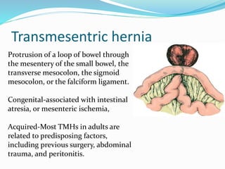 Internal hernia | PPTX