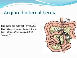 Internal hernia | PPTX