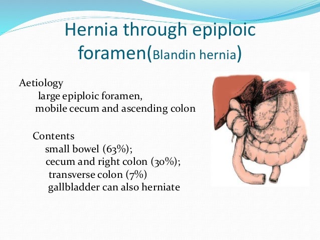 Internal hernia