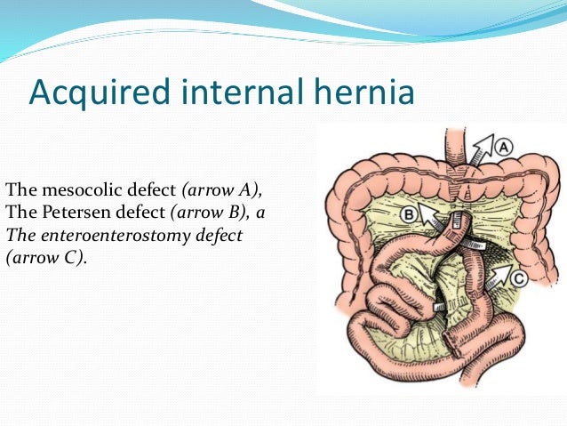 Internal hernia