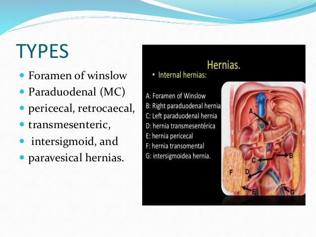 Internal hernia
