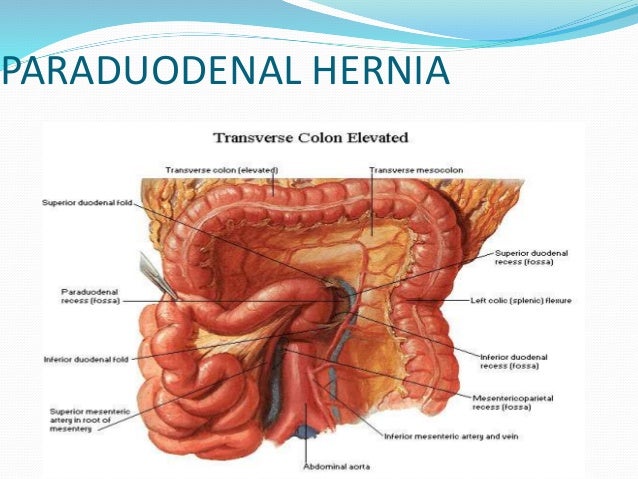 Internal hernia
