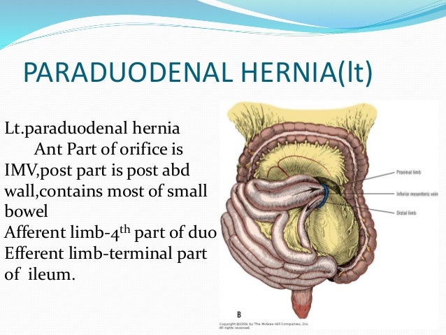 Internal hernia