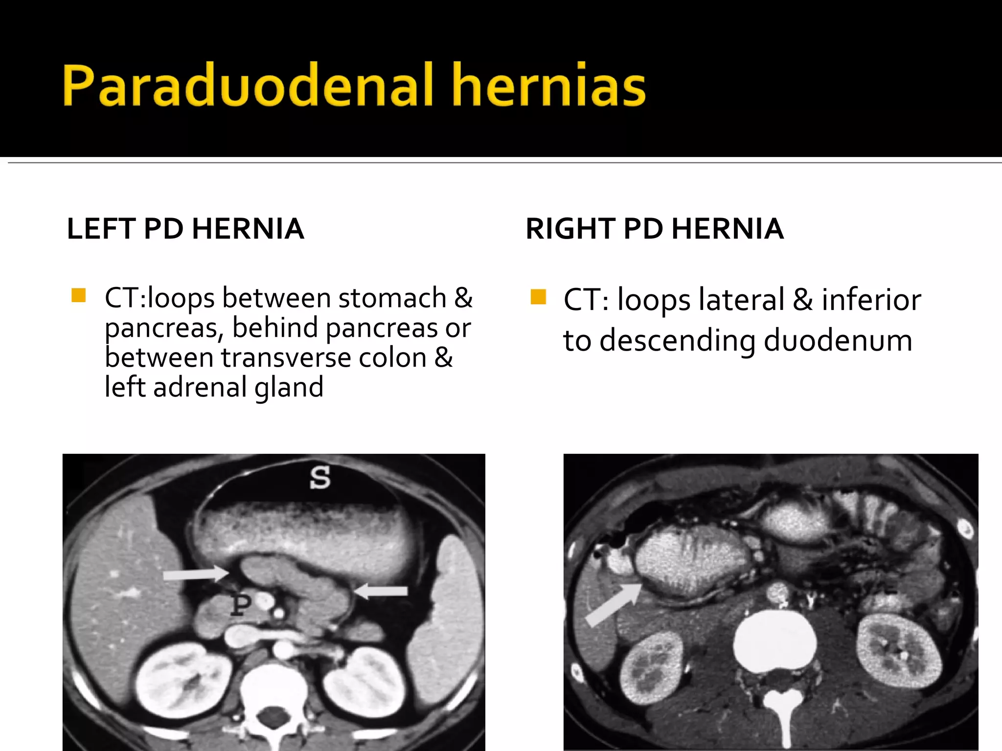Internal hernia | PPT
