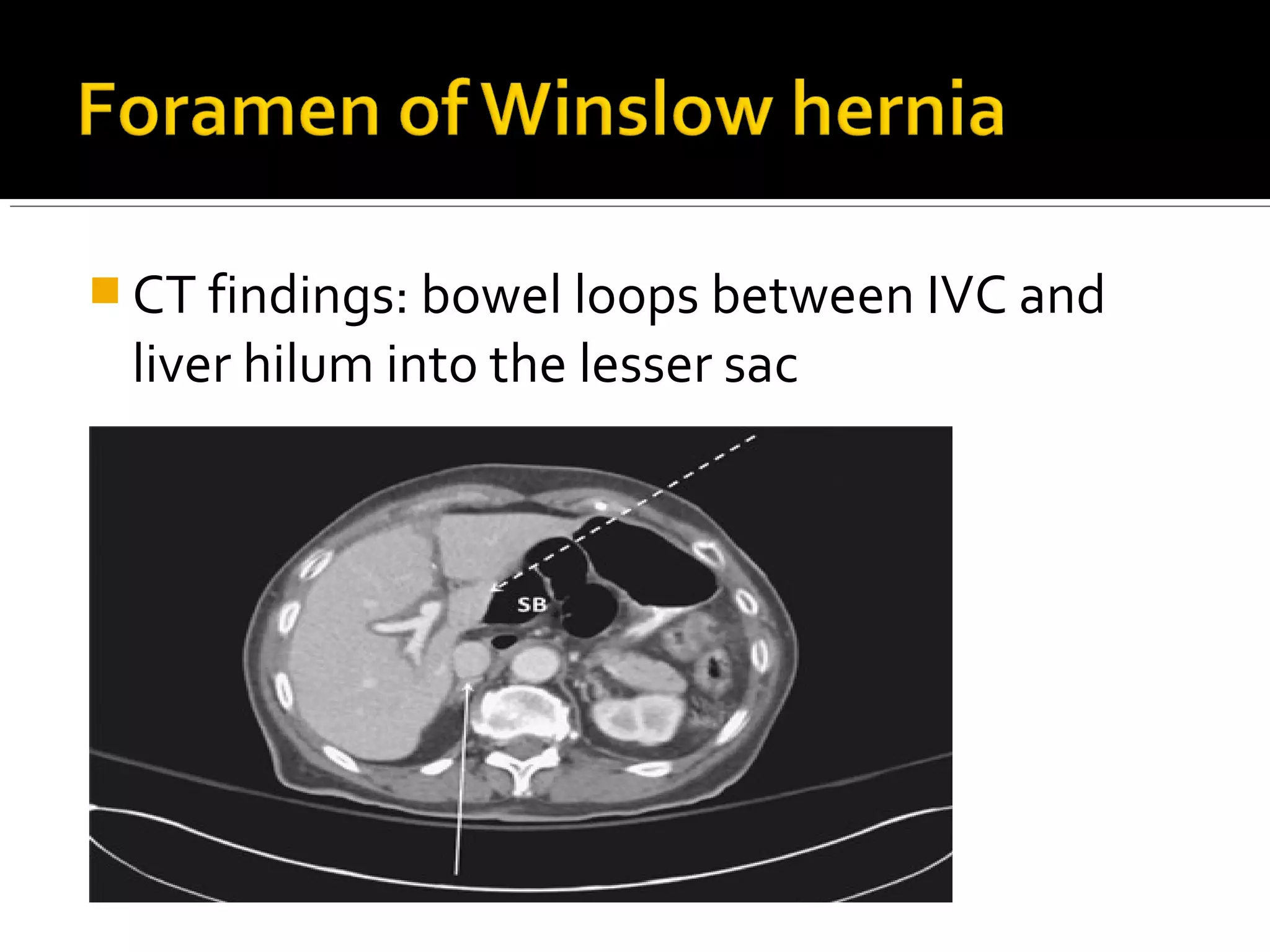 Internal hernia | PPT