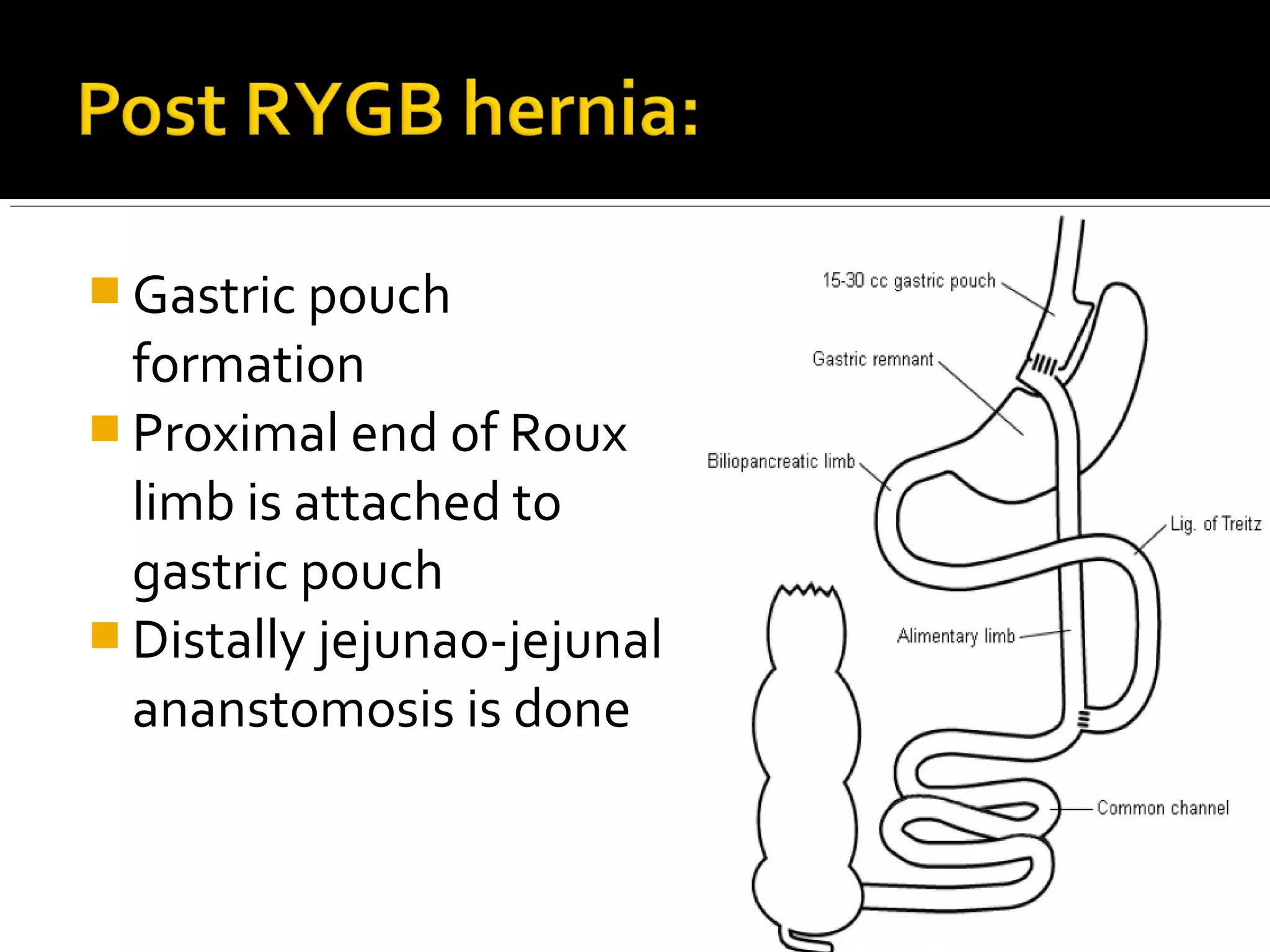Internal hernia | PPT