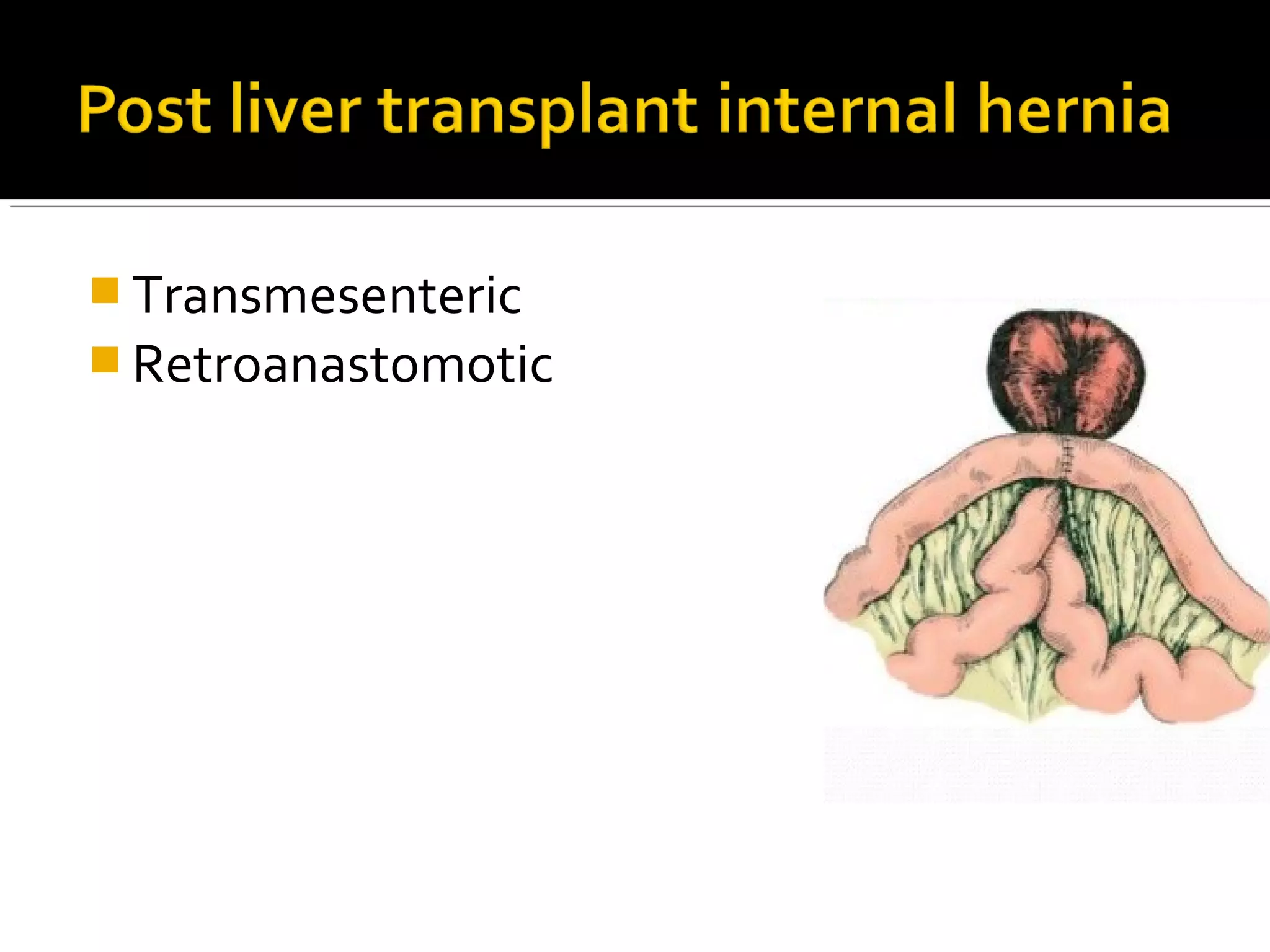 Internal hernia | PPT