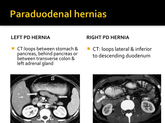 Internal hernia | PPT | Surgery | Medical Health