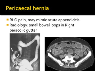 Internal hernia | PPT