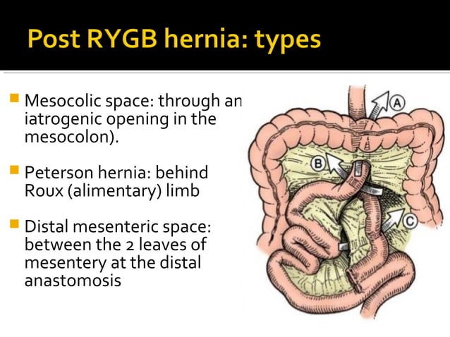 Internal hernia | PPT | Surgery | Medical Health