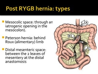 Internal hernia | PPT