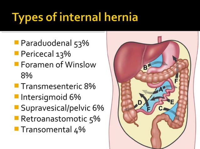 Internal hernia | PPT
