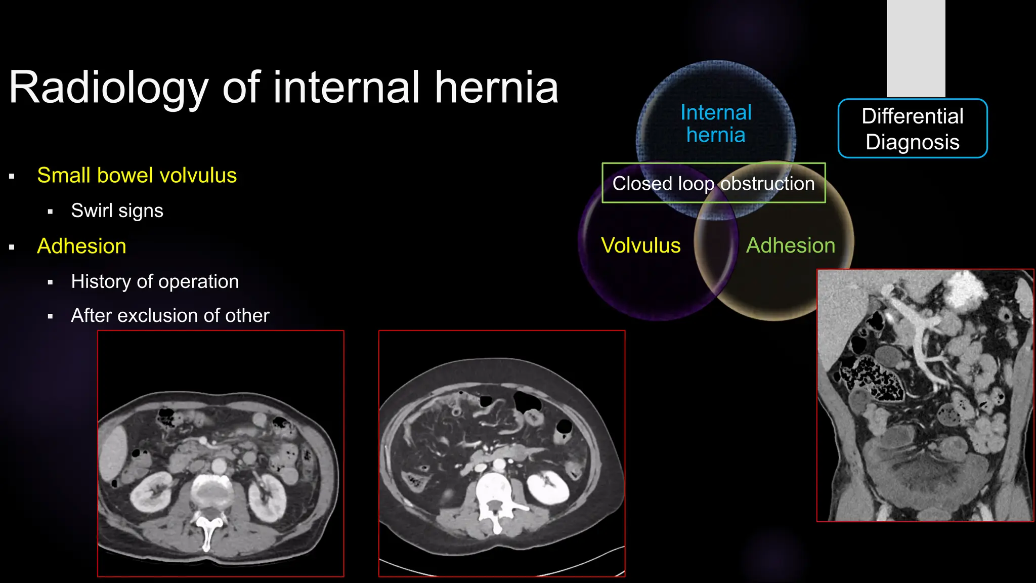 Internal hernia radiology by Dr. Abdelkarim.pdf
