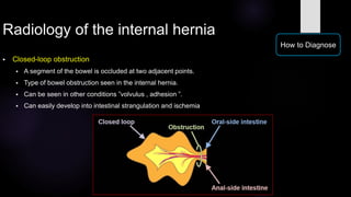 Internal hernia radiology by Dr. Abdelkarim.pdf
