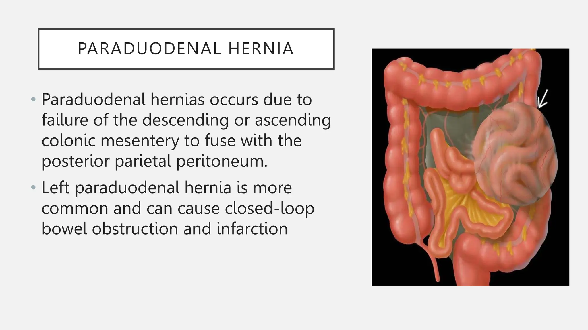 INTERNAL HERNIAS. pptx internal herniass | PPTX