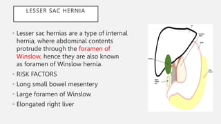 INTERNAL HERNIAS. pptx internal herniass | PPTX