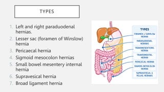 INTERNAL HERNIAS. pptx internal herniass | PPTX