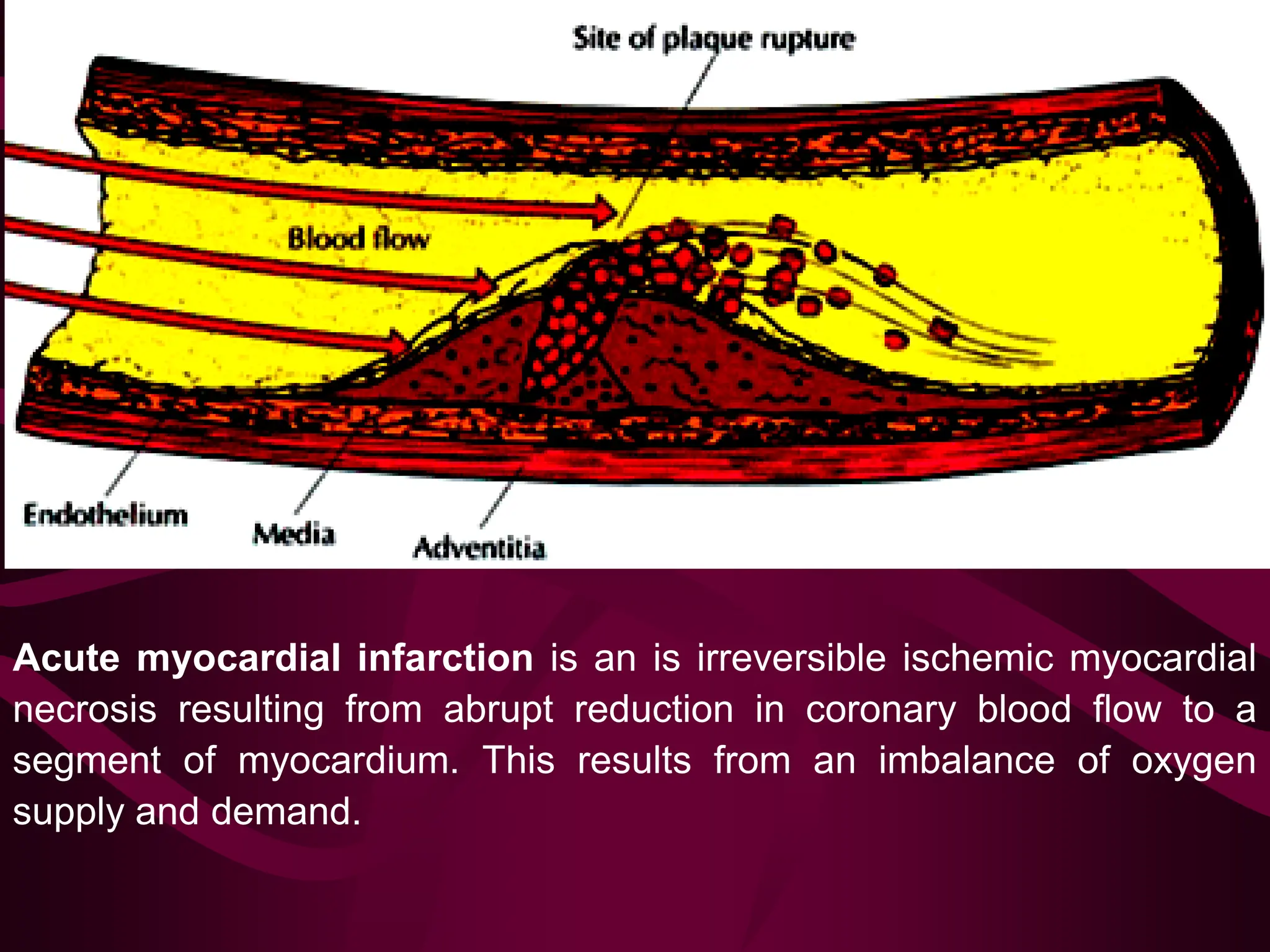 Internal Medicine Lecture 3 Acute coronary syndrome Myocardial ...