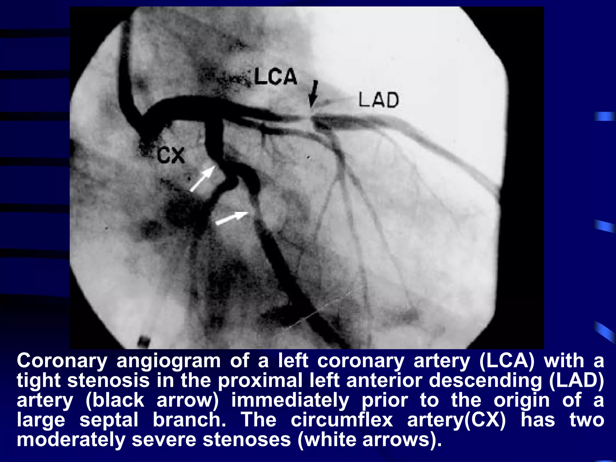 Internal Medicine Lecture 4 Chronic forms of ischemic heart disease.pdf