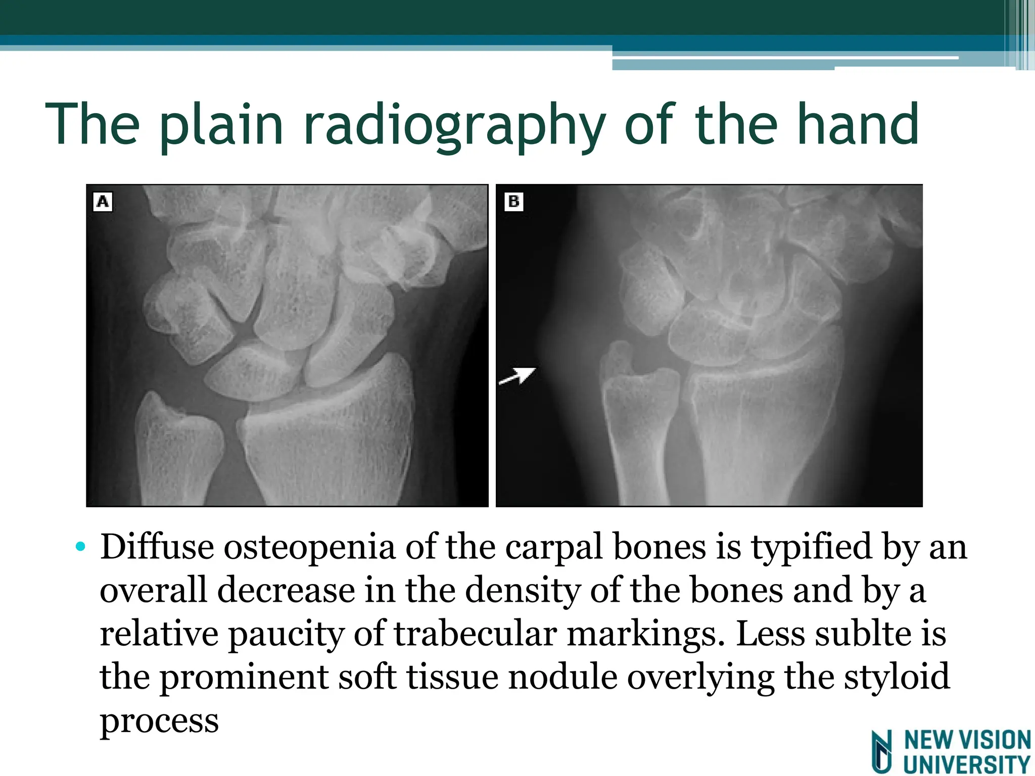 Internal Medicine Topic 9 OA and RA.pptx