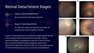 International-Classification-of-Retinopathy-of-Prematurity.pptx