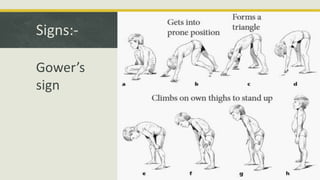 Duchenne Muscular Dystophy ppt | PPT